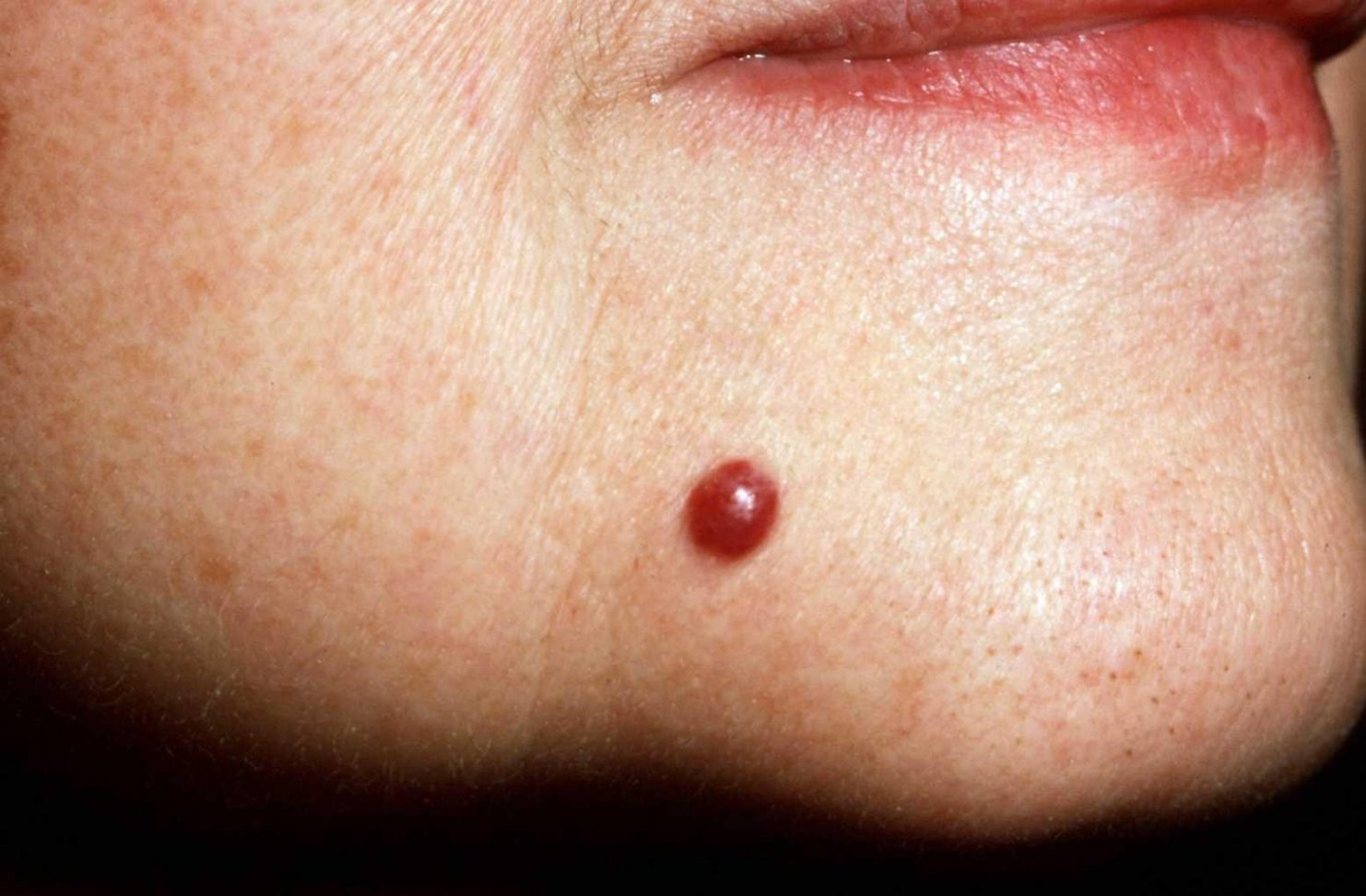 What Do Red Moles on Your Skin Mean? | Life Sciences